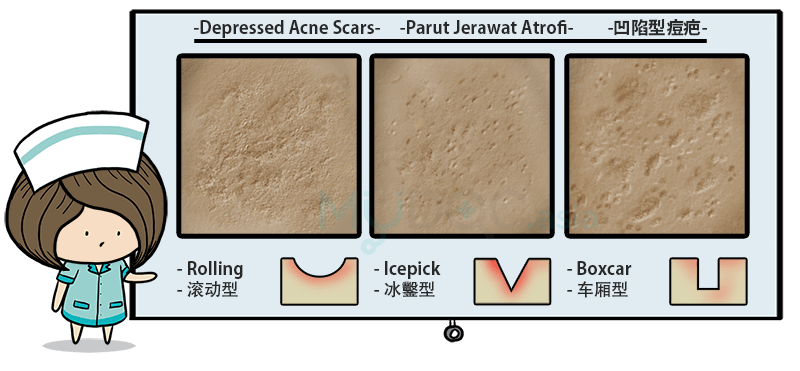 After Battling Acne, My Face is Now Full of Acne Scars | Erufu Care