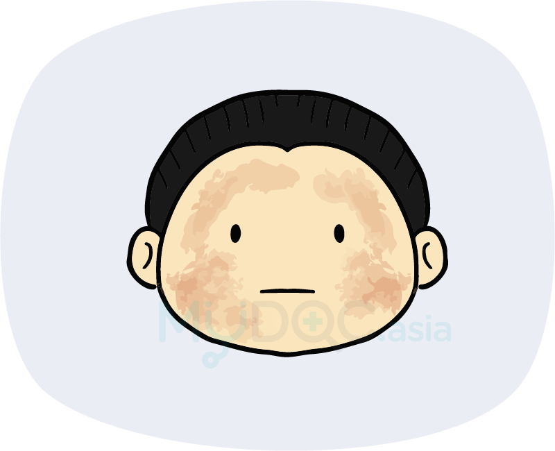 Pigmentation? Here’s How to Differentiate between Freckles, Melasma ...