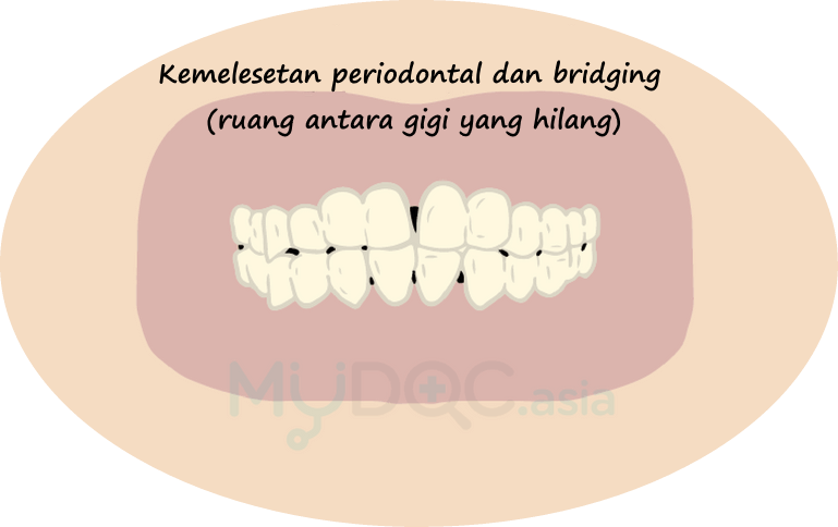 Tanya Doktor: Adakah Saya Sudah Tua Untuk Memakai Pendakap Gigi ...