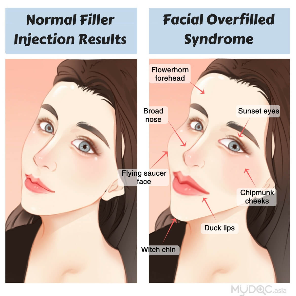 Dermal Fillers - Can We Have Too Much? The Doctor Explains | Erufu Care
