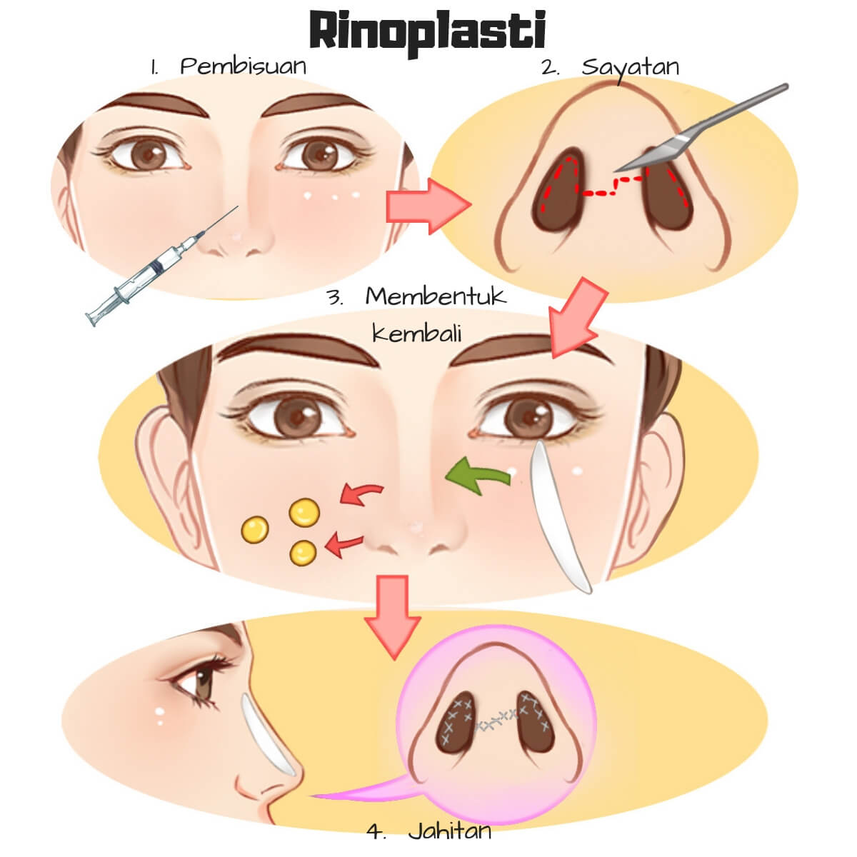 Bagaimana Cara Rinoplasti atau Operasi Hidung Dilakukan di Malaysia ...