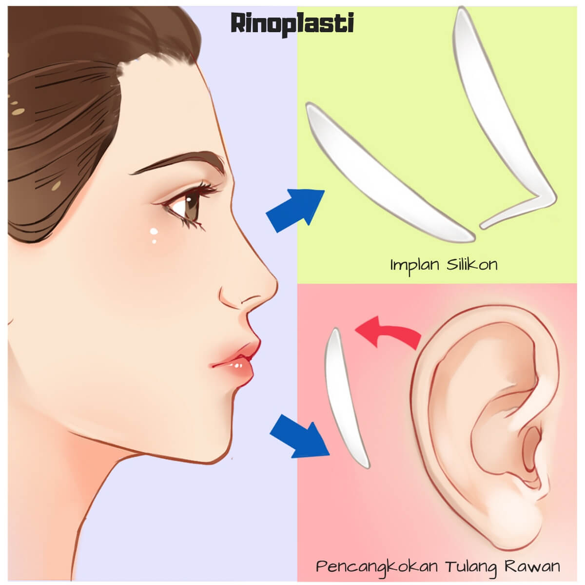 Bagaimanakah Rinoplasti dan Hidung Mancung tanpa bedah dilakukan di ...