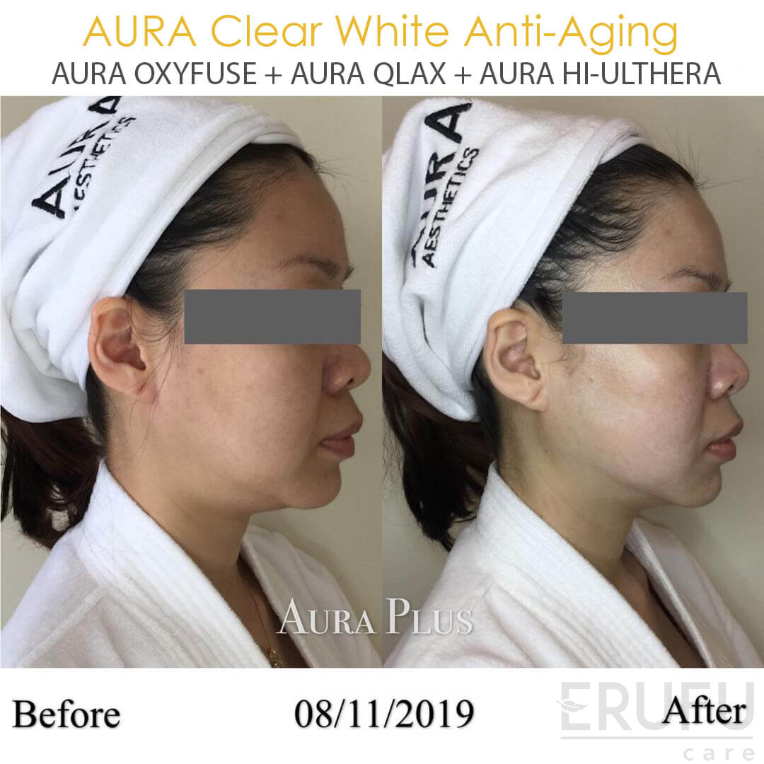 Aura Plus - Medical Aesthetics & Anti-Aging - Price & Reviews | Erufu Care