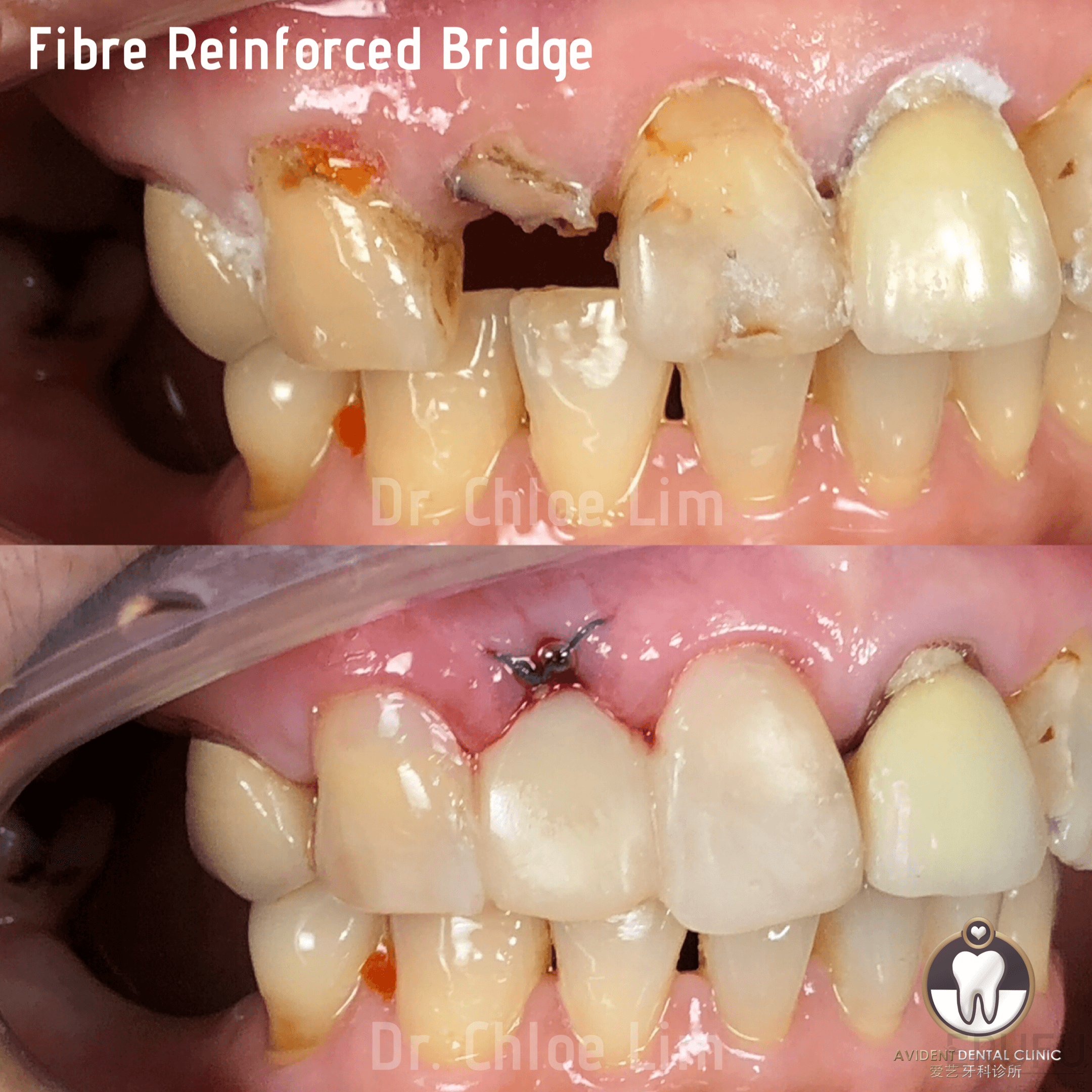 16 Best Root Canal Treatment in Kuala Lumpur - Price Guide & Reviews