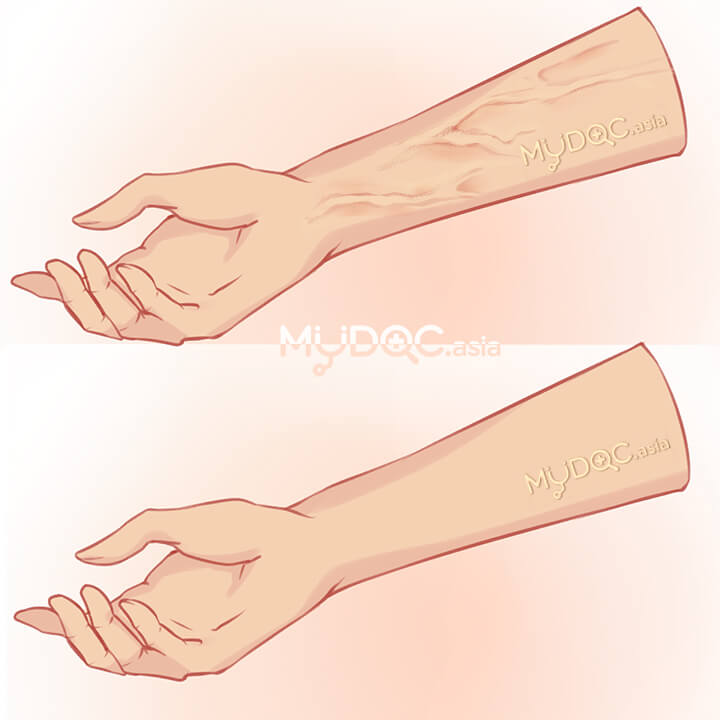 Best Arteriovenous Fistula (AVF) in Johor Bahru - Price Guide & Reviews